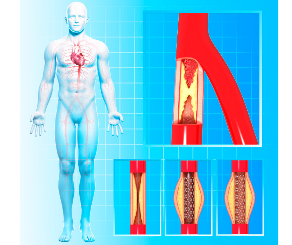 Peripheral Arterial Disease Symptoms Diagnosis And Treatment