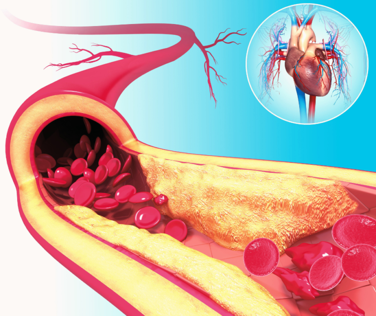 Peripheral Arterial Disease: Symptoms, Diagnosis, and Treatment