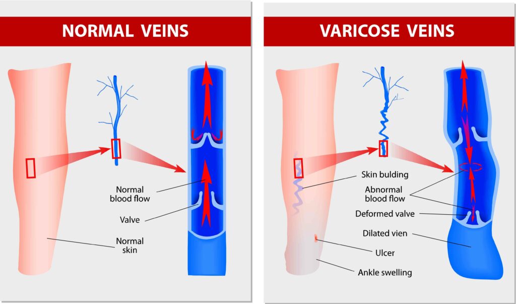 Understanding Varicose Veins: Causes, Symptoms, and Treatments